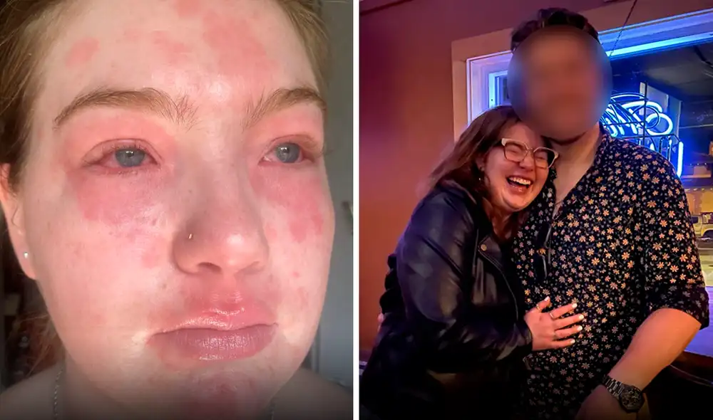 Viral | Estados Unidos | El insólito caso de la mujer que es alérgica a ...