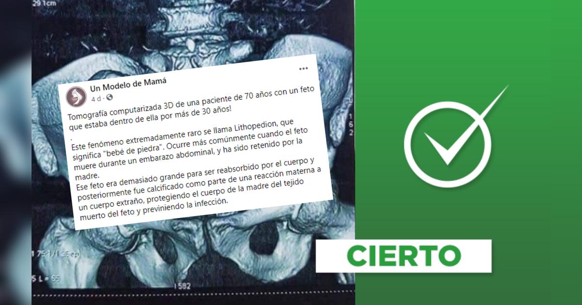 Imagen corresponde a caso de litopedion o “feto calcificado”: es una ...