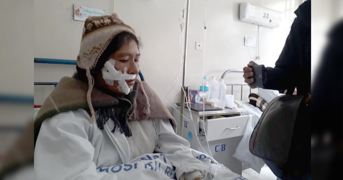 Puno Mujer Desfigurada Por Conviviente Lo Acusa De Abusar De Su Hija