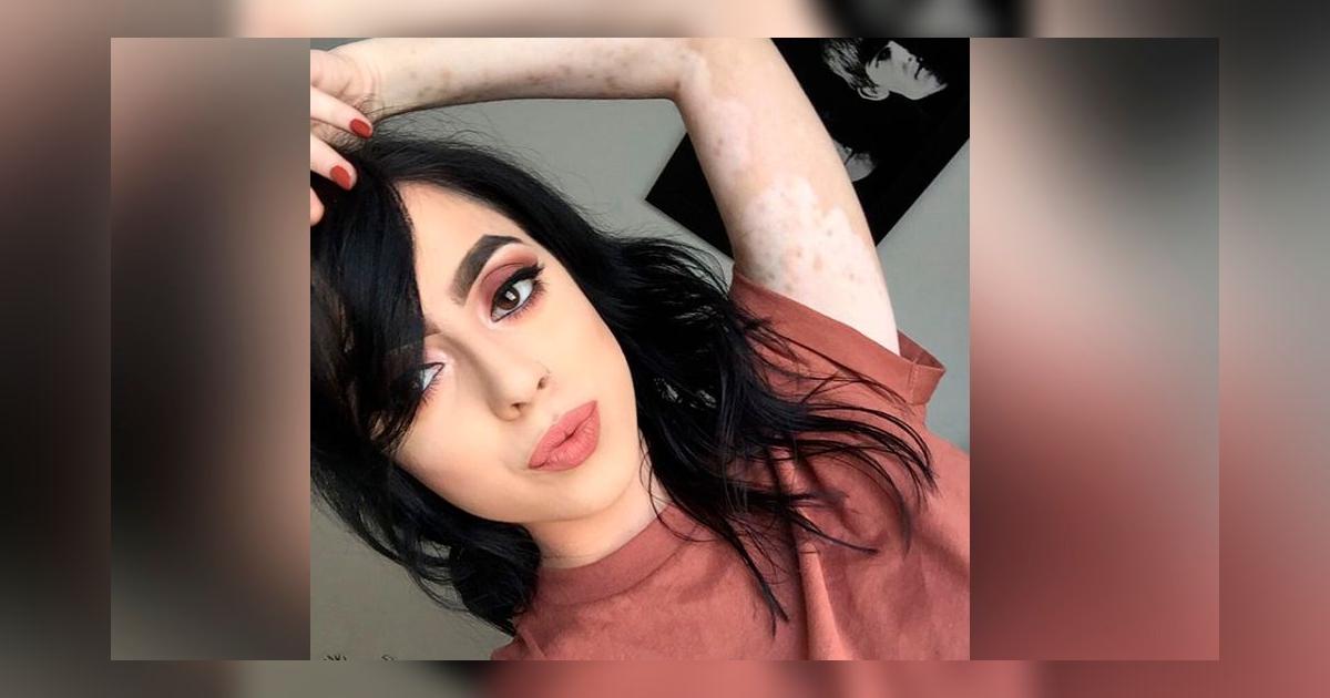 Instagram: fotos de modelo con vitiligo es tendencia | Fotos | Viral ...