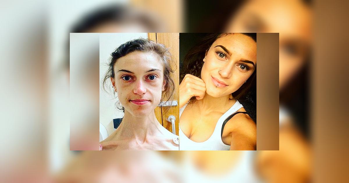 En Instagram, joven vence anorexia y su radical cambio sorprende a ...