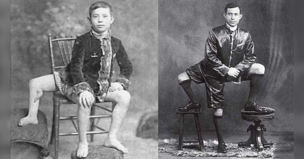 La increíble historia de Frank Lentini: ¿por qué nació con tres piernas ...