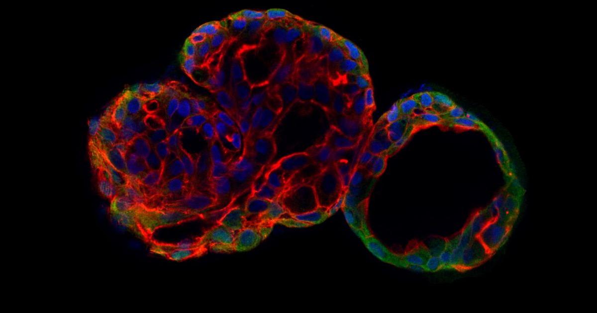 ADN de 12.000 tumores revela pistas clave sobre el origen del cáncer ...