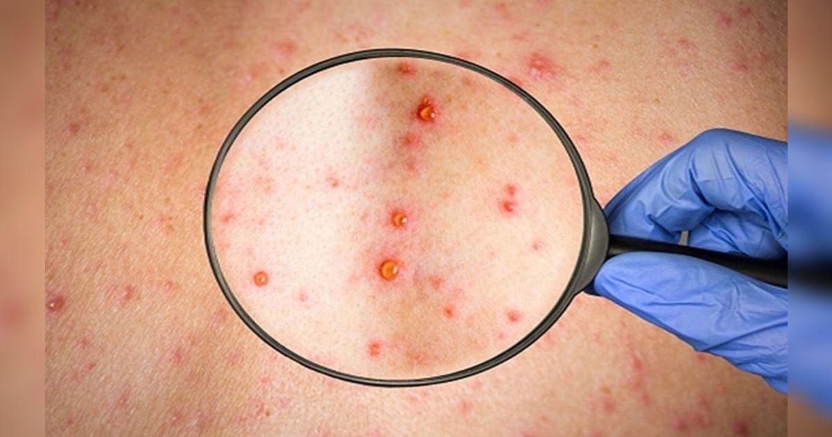 ¿Qué es la viruela del mono, la rara infección que se propaga en Europa ...