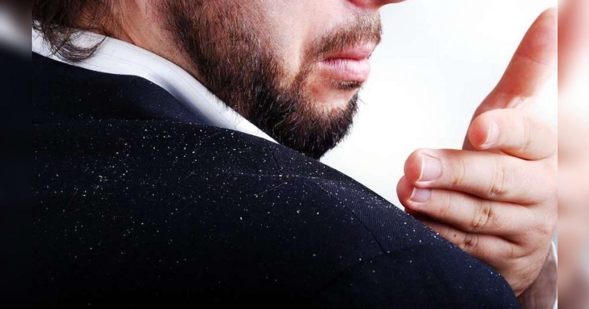 Estrés: ¿cuando estamos estresados nos aparece caspa? | Salud | La ...