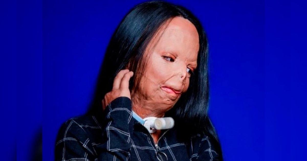 ¿Quién es Aleema Ali, la joven víctima de quemaduras que triunfa entre ...