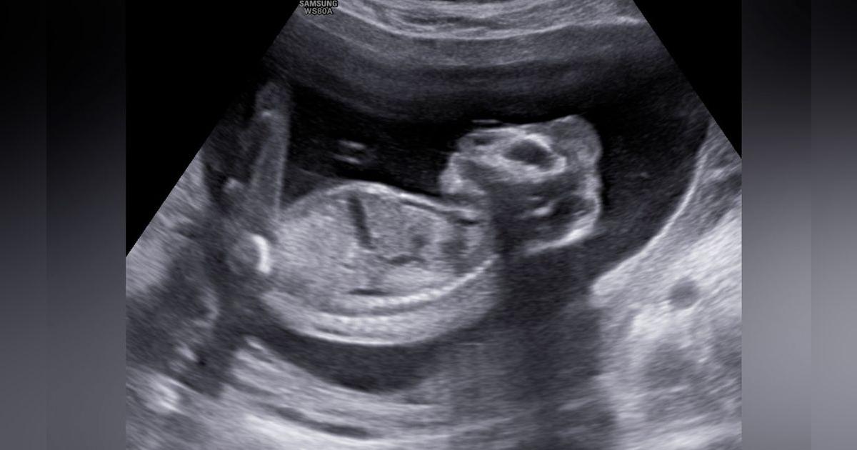 Viral | Niegan aborto a mujer embarazada de un feto sin parte del ...