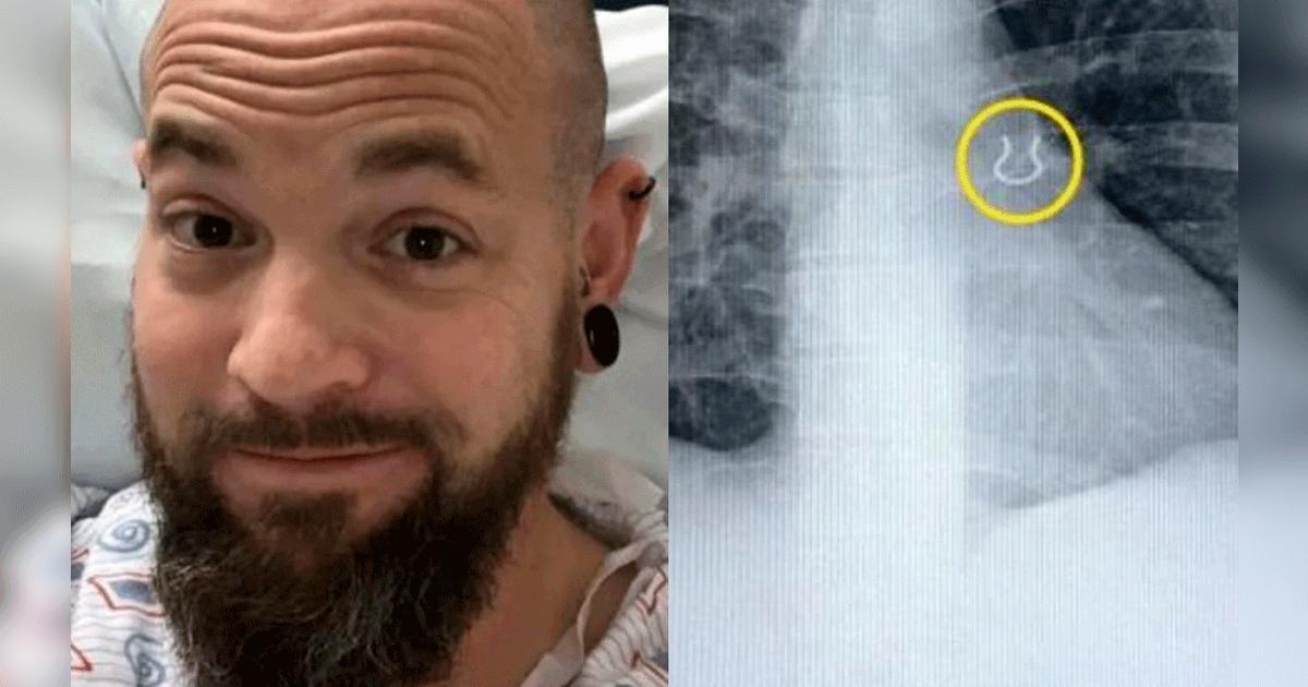 Viral: No dejaba de toser, se hizo una radiografía y descubrió que ...