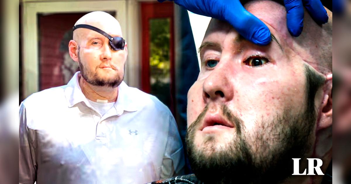 Médicos de EE. UU. logran realizar el primer trasplante de ojo en el mundo | Ciencia | La República