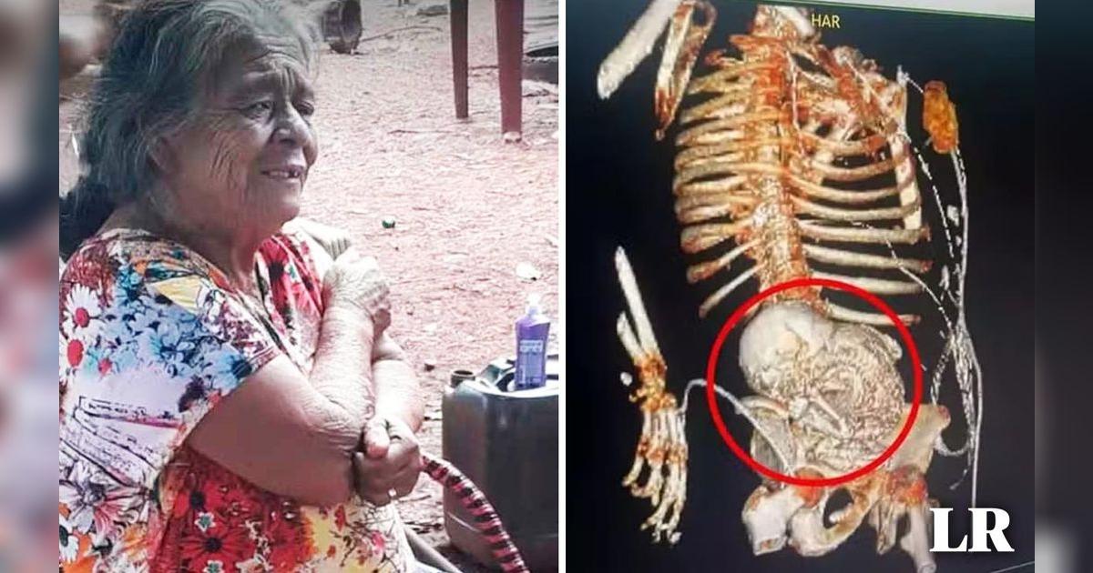 Brasil | Mujer descubre que tenía un feto calcificado desde hace 56 ...