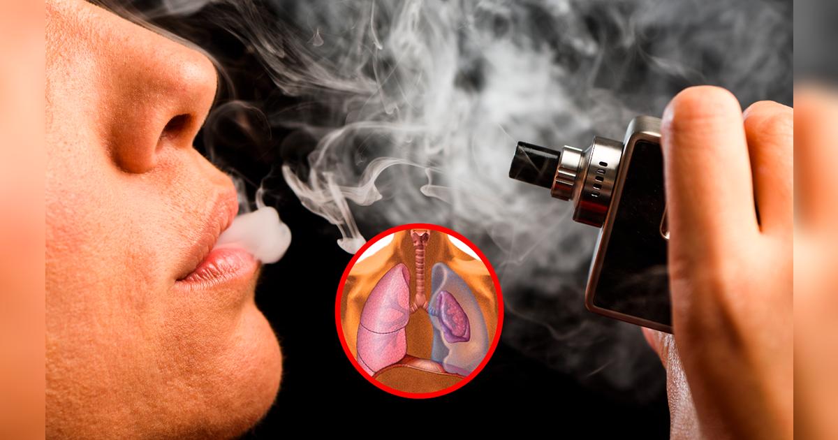 Joven sufre colapso pulmonar por uso excesivo de cigarros electrónicos ...
