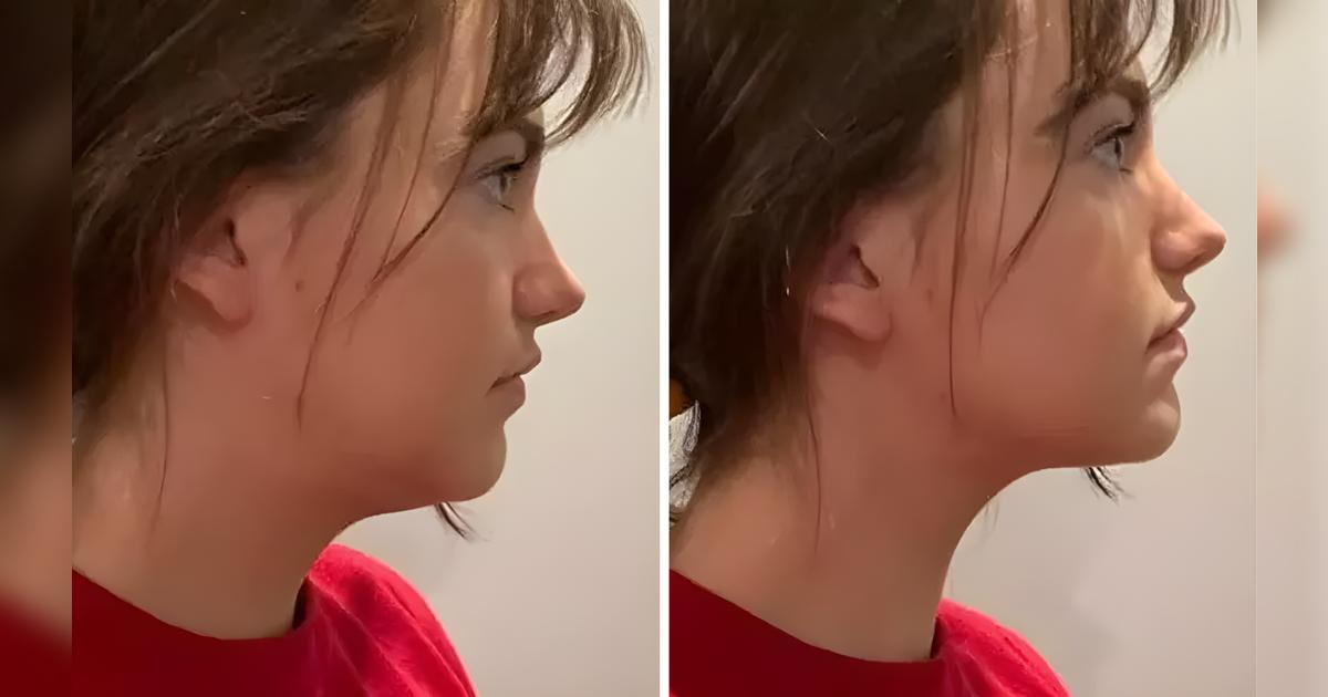 ¿Qué es el 'mewing'? El ejercicio viral de TikTok que promete ...