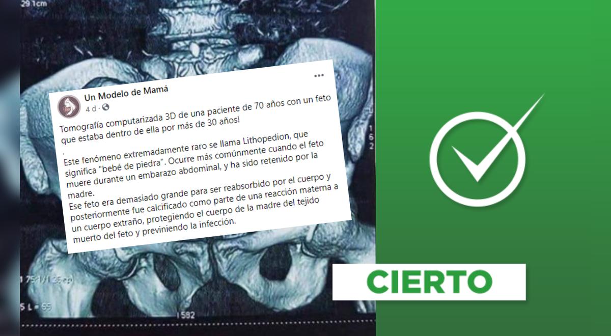 Imagen corresponde a caso de litopedion o “feto calcificado”: es una ...
