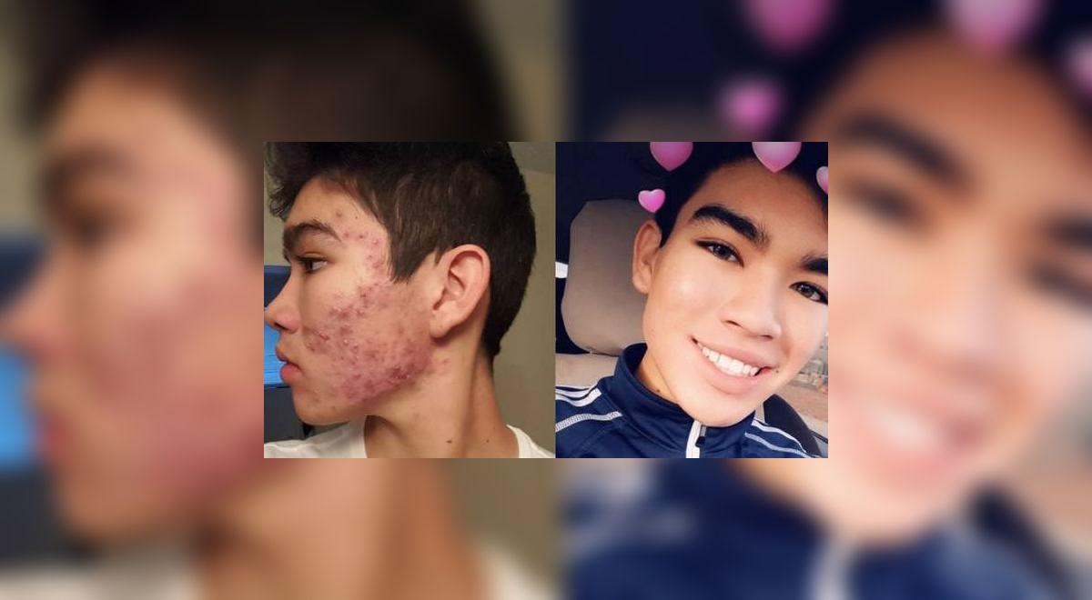 YouTube: el extraño tratamiento que uso adolescente para vencer acné ...