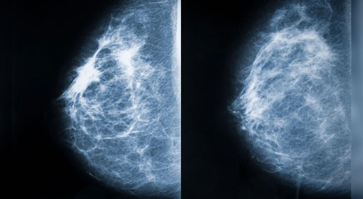 Nuevo fármaco frena el cáncer de mama metastásico en el 75% de los ...