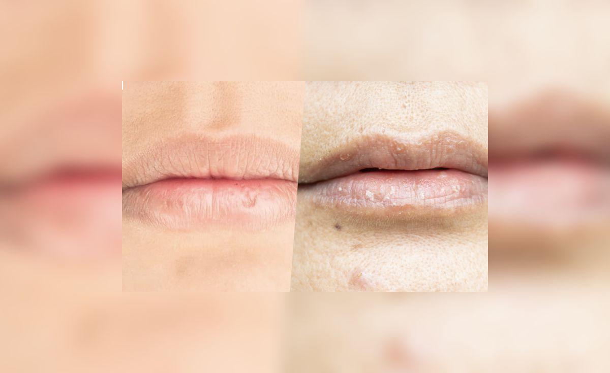 Labios resecos y agrietados: qué provoca la sequedad labial ...