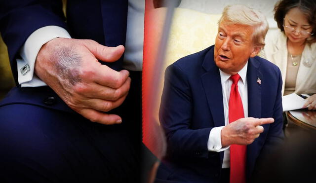 Trump aparece con moretones en las manos y genera preocupación por su ...