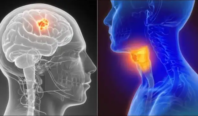 Nuevo tratamiento destruye tumores del cáncer de cabeza y cuello, según ...